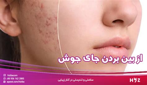 کرم از بین بردن جای جوش صورت وبدن انواع بهترین کرم های از بین بردن جای جوش های زیبا