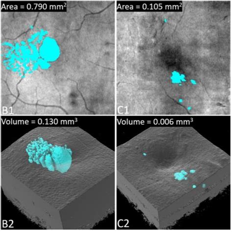 Automated Retinal Fluid Segmentation Results On Shadow Artifact Download Scientific Diagram