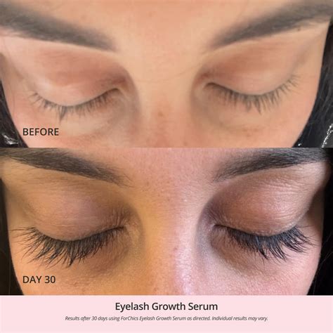 Lash Serum Side Effects Risks You Should Know Forchics