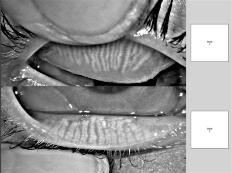 Normal Meibomian Glands Meibomian Gland Imaging And Expression Dry