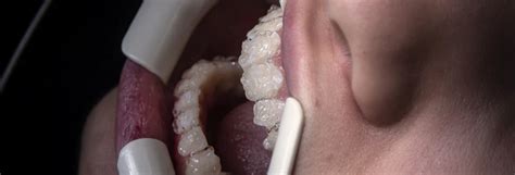 Dental Anatomy Maxillary Second Premolar