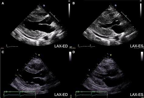 Acute Myocarditis Complicating Systemic Lupus Erythematosus