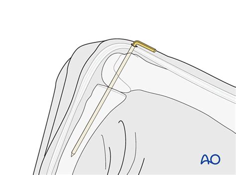 Reduction With Or Without Joint Transfixation For Dislocation Of The