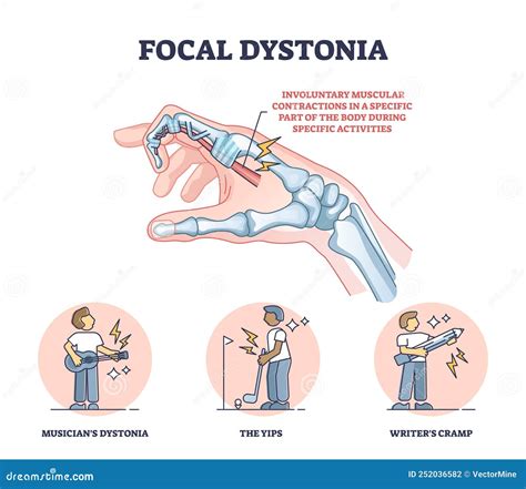 Focal Dystonia As Anatomical Neurological Muscle Disorder Outline