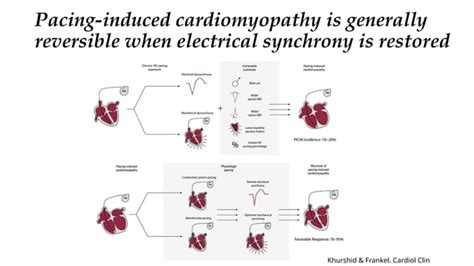 Review Of Conduction System Pacing Pptx