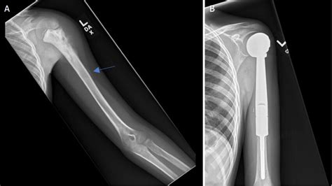 Anteroposterior Radiographs Of A 10 Year Old Male With Osteosarcoma Of Download Scientific
