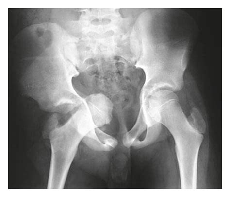 Displaced Right Acetabular Fracture Dislocation With Anterior Column Download Scientific