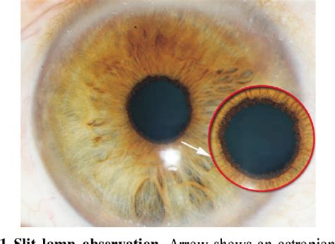 Angiography Reveals Early Hiding Iris Neovascularization After Ischemic Crvo Semantic Scholar