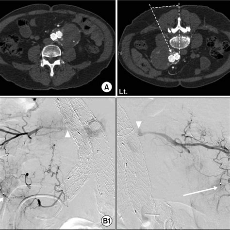 A Type Ii Endoleak B Transarterial Approach Was Failed Due To Download Scientific Diagram