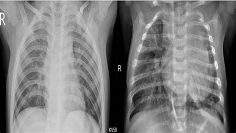 Github Daniellejenkins17 Pneumonia Classification Determining Whether Or Not A Patient Has
