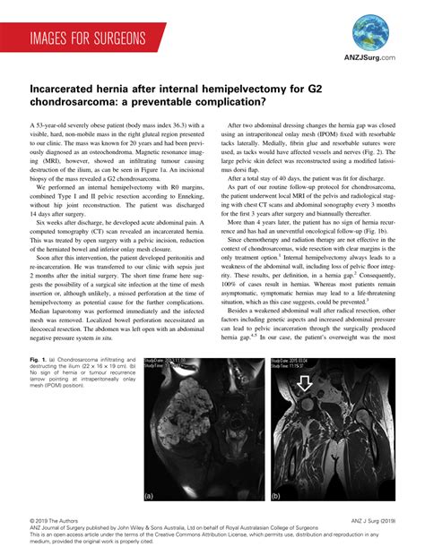 Pdf Incarcerated Hernia After Internal Hemipelvectomy For G2 Chondrosarcoma A Preventable