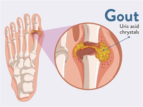 Bone Clinic And Neurosurgeon Contact Us 65 31381235 Gout Pain