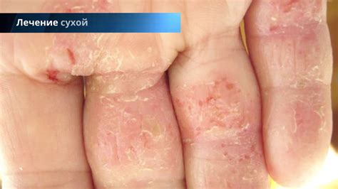 Сухая экзема на руках и ногах причины симптомы методики лечения и профилактика Youtube