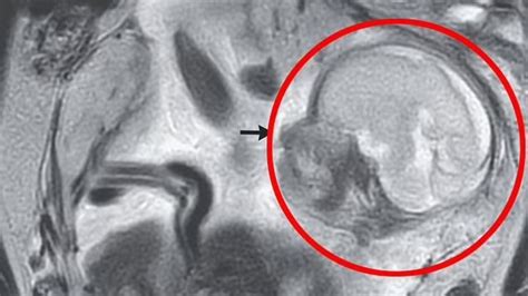 Rare Ectopic Pregnancy Discovered In X Ray Baby Survives NT News