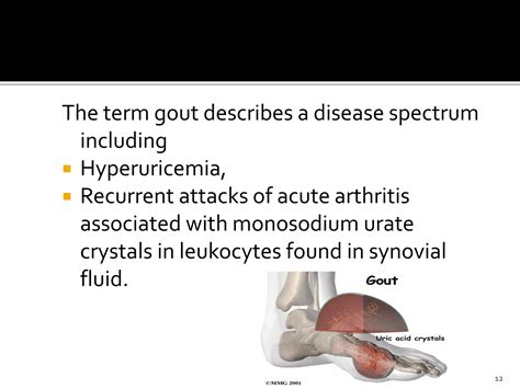 Gout And Hyperuricemia Pptx