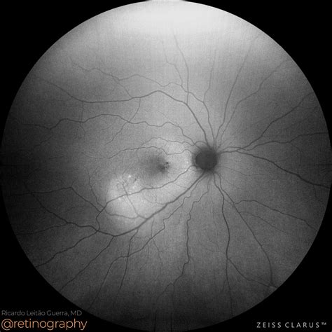 Central Serous Chorioretinopathy Retinography