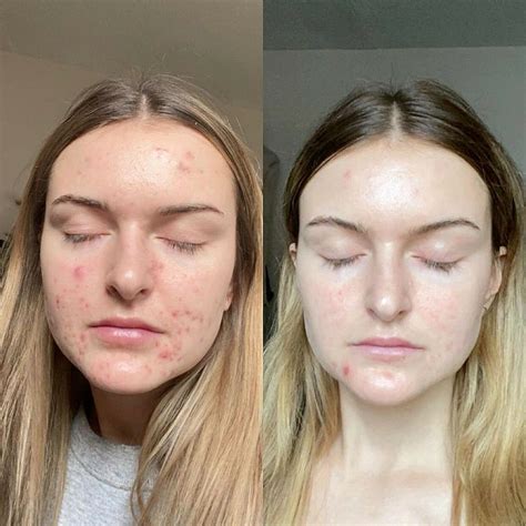Tretinoin Before And After Acne