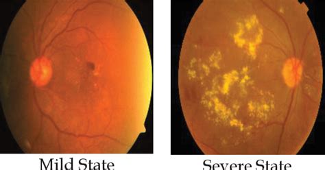 Figure 2 From Enhancing Diabetic Retinopathy Detection Accuracy With Convolutional Neural