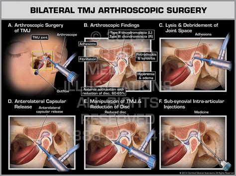 Bilateral Tmj Arthroscopic Surgery
