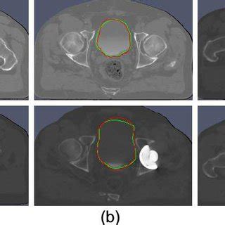 HF UNet Learning Hierarchically Inter Task Relevance In Multi Task U Net For Accurate Prostate