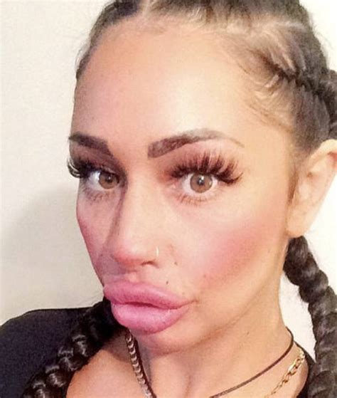 This Mum Has Already Huge Lips But She Wants Them Even Bigger 11 Pics