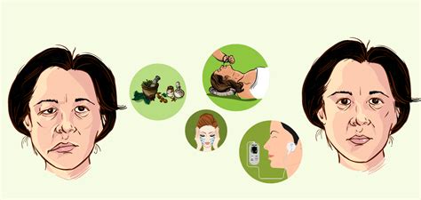 Holistic Ways To Manage Bells Palsy Happiest Health
