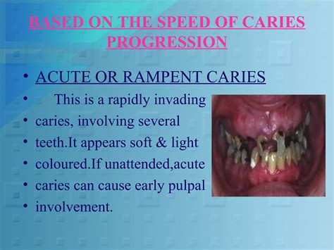 Aetiopathology And Classification Of Caries Ppt