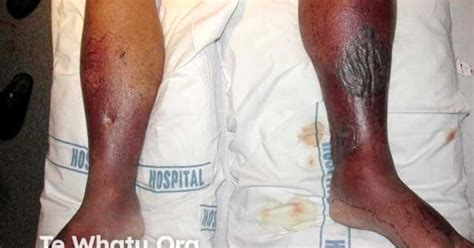 Warfarin Induced Skin Necrosis Image