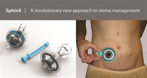 SphinX Ostomy Management Device Babe Of International BIOdesign