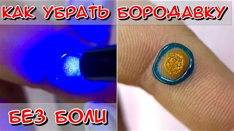 Бородавка на пальце Как выглядит бородавка Как лечить бородавку Что такое бородавка ВПЧ