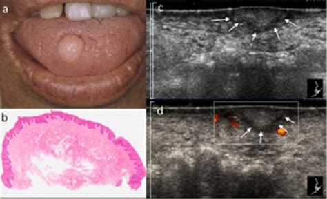 Fibrous Polyp A Clinical View Of The Lesion B Low Power
