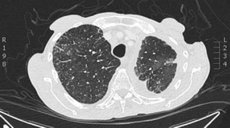 2 Lymphangitis Ct Scan Of Chest Axial View Showing Bilateral Nodular