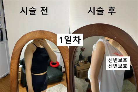 [다이어트주사] 단기간 살빼기 프로젝트 스타트 다이어트방법 비만클리닉 팔뚝주사 상담 및 시술 직후편 네이버 블로그