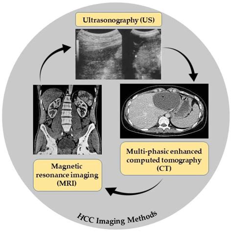 Hepatocellular Carcinoma