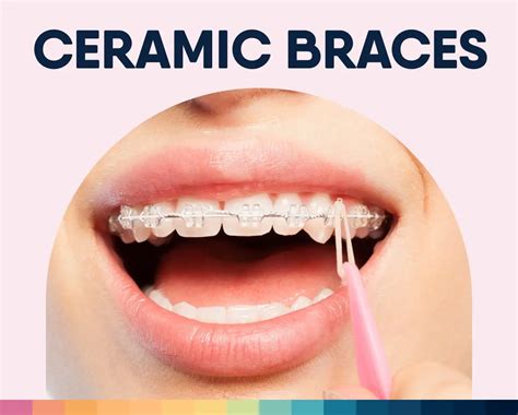 How Much Do Braces Cost Aspen Dental