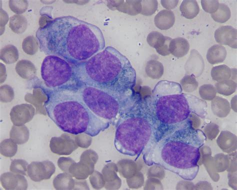 Melanoma Archives Eclinpath