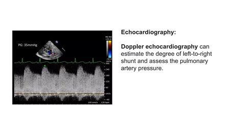 Patent Ductus Arteriosus Pda Echocardiographic Assessment Anatomy