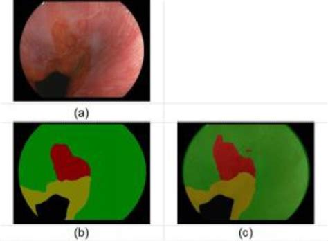 a self supervised semantic segmentation method for identifying barrett