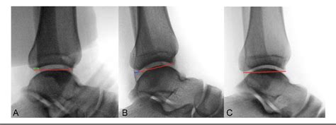 Figure 1 From An Assessment Of Normal Tibiofibular Anatomy On Lateral Fluoroscopy Semantic Scholar
