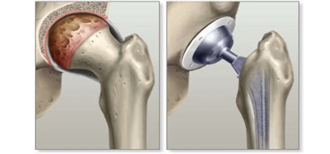 Guide To Faster Recovery Total Hip Replacement West Tennessee Bone And Joint Institute