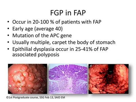 Management Of Gastric Polyps Pptx