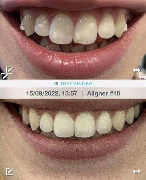 Completed 18 Initial Trays 16 Refinement Trays 14 Months What Do We Think Invisaligners