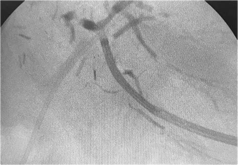 Percutaneous Cholangioscopy Assisted Rendezvous Endoscopic Retrograde