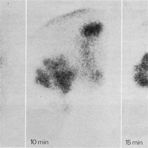 Fig Preoperative Technetium M Pertechnetate Scans Showing Diffuse Download Scientific Diagram