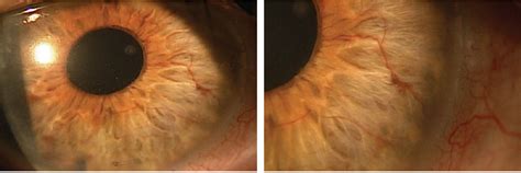 Neovascularization Of Iris