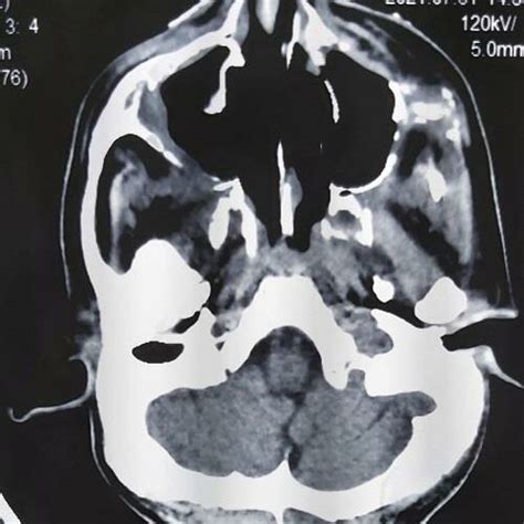 Clinical Picture Showing The Surgical Procedure Of Partial Maxillectomy Download Scientific
