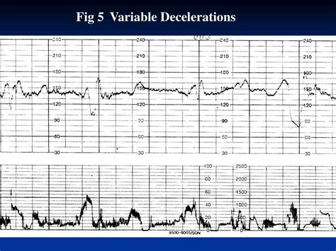 Ppt Cardiotocography Ctg Electronic Fetal Monitoring Powerpoint