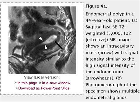 Endometrial Polyp Semantic Scholar