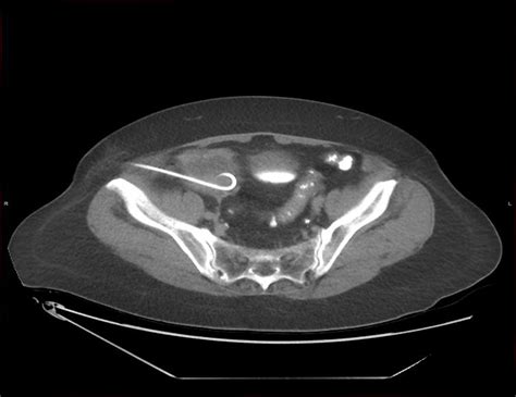 Two Step Procedure For Complicated Appendicitis With Perityphlitic Abscess Formation
