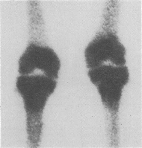 Technetium 99m Pyrophosphate Bone Scan Showing Intense Uptake Of